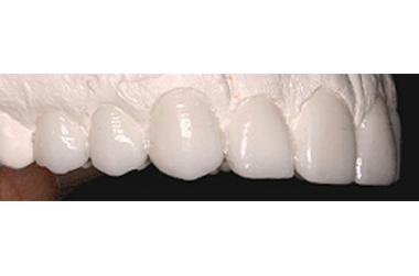 Crown and Bridge - Richley Dental Ceramics