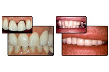 Crown and Bridge - Richley Dental Ceramics